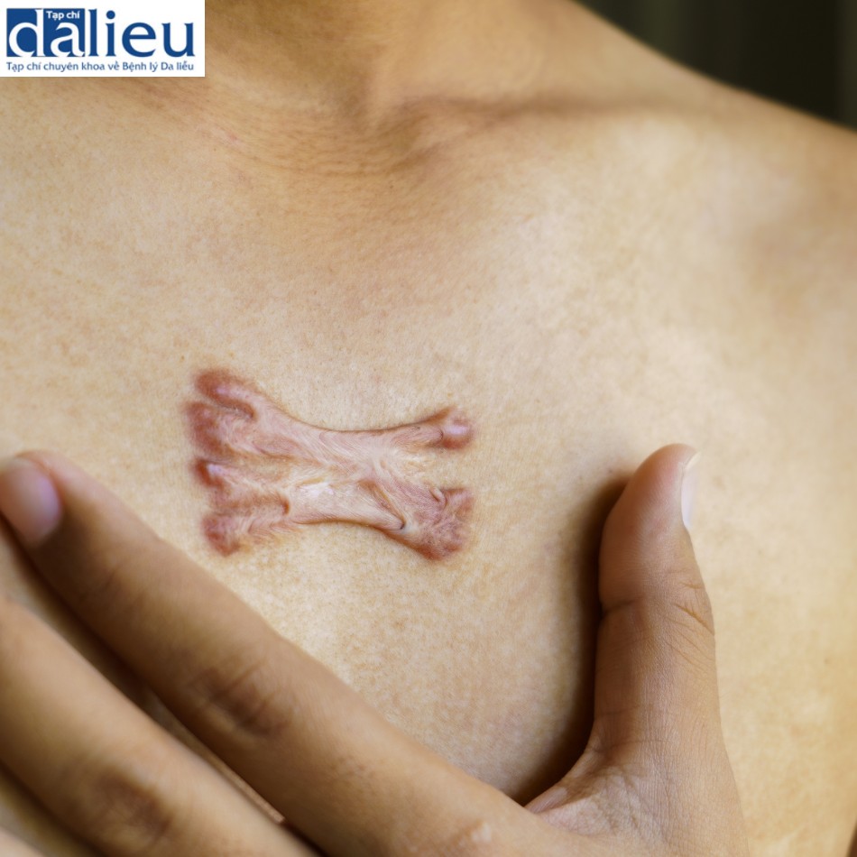 Tìm hiểu về các kiến thức liên quan đến di truyền học của sẹo và sẹo lồi